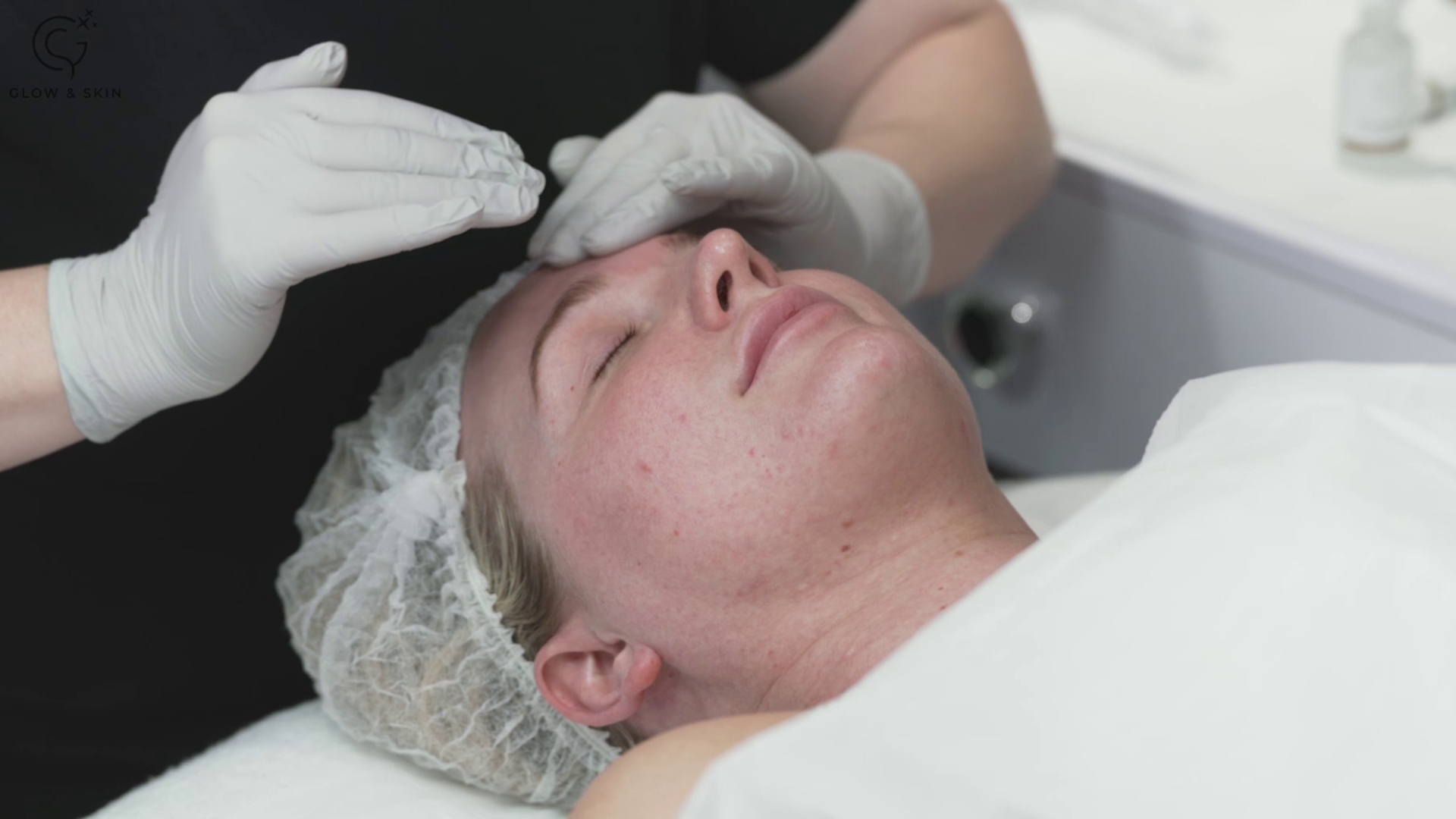 Understanding Acne | Iconic Facial | Led Light Therapy